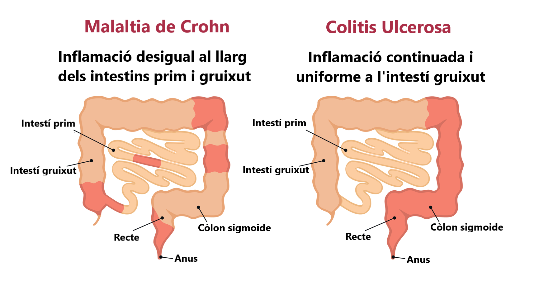Crohn i colitis ulcerosa - ACCU Catalunya